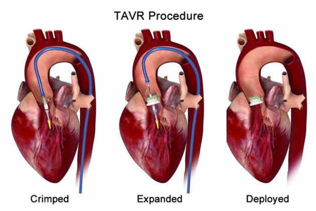 Implantimi i valvulës së aortës transkateterike (TAVI) | Spitali Gjerman